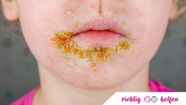 Eiterflechte - Behandlungsmöglichkeiten und vorbeugende Maßnahmen ...